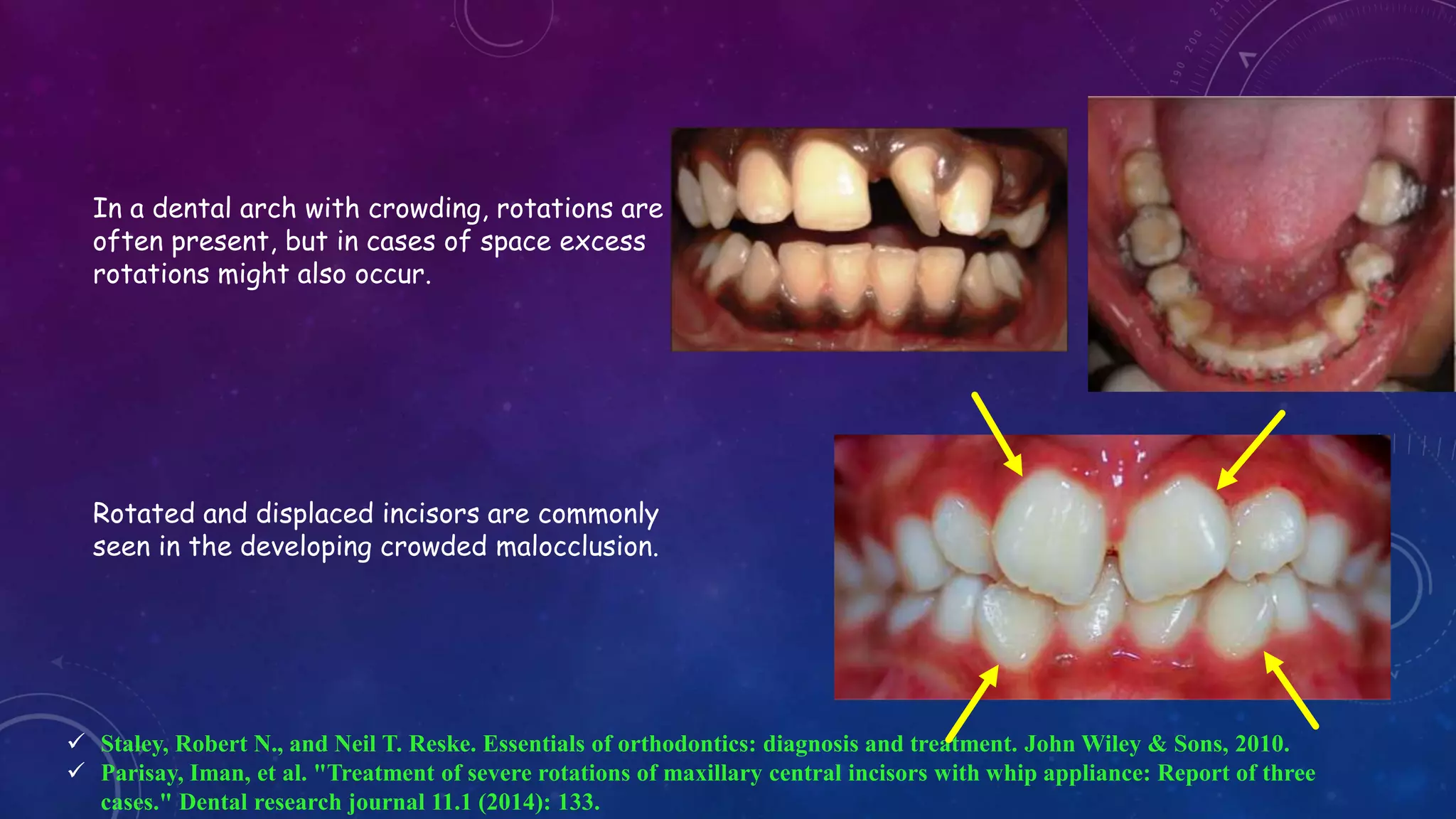 Orthodontic Correction of Rotated Teeth | PPTX