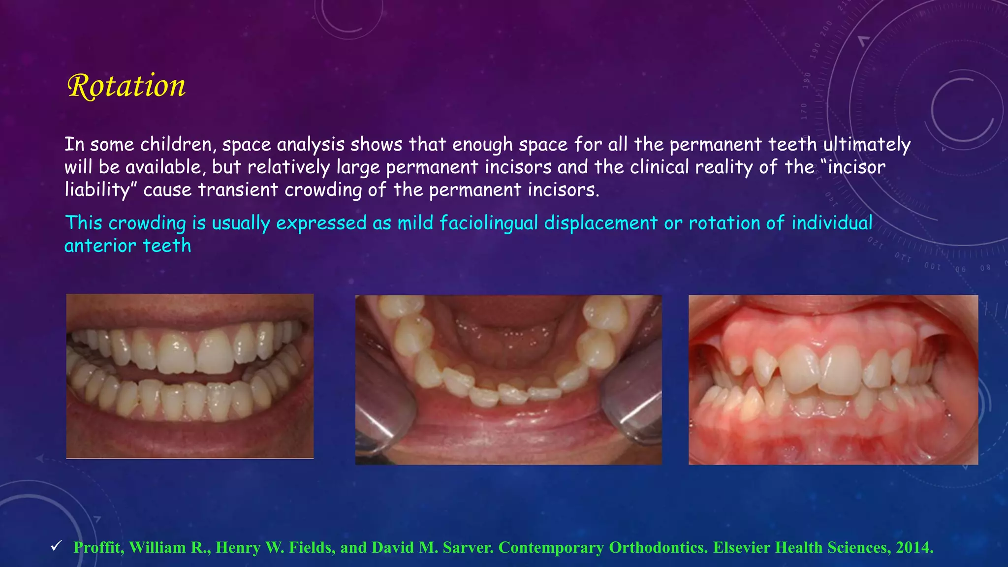 Orthodontic Correction of Rotated Teeth | PPTX