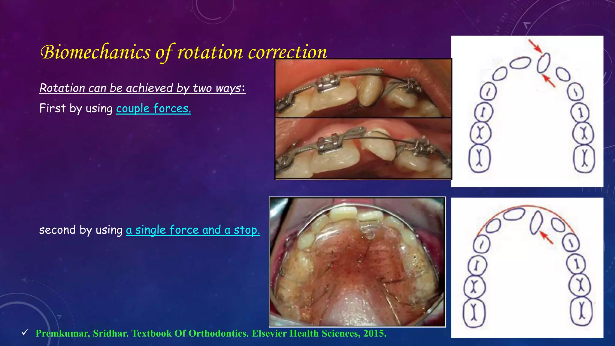 Orthodontic Correction of Rotated Teeth | PPTX