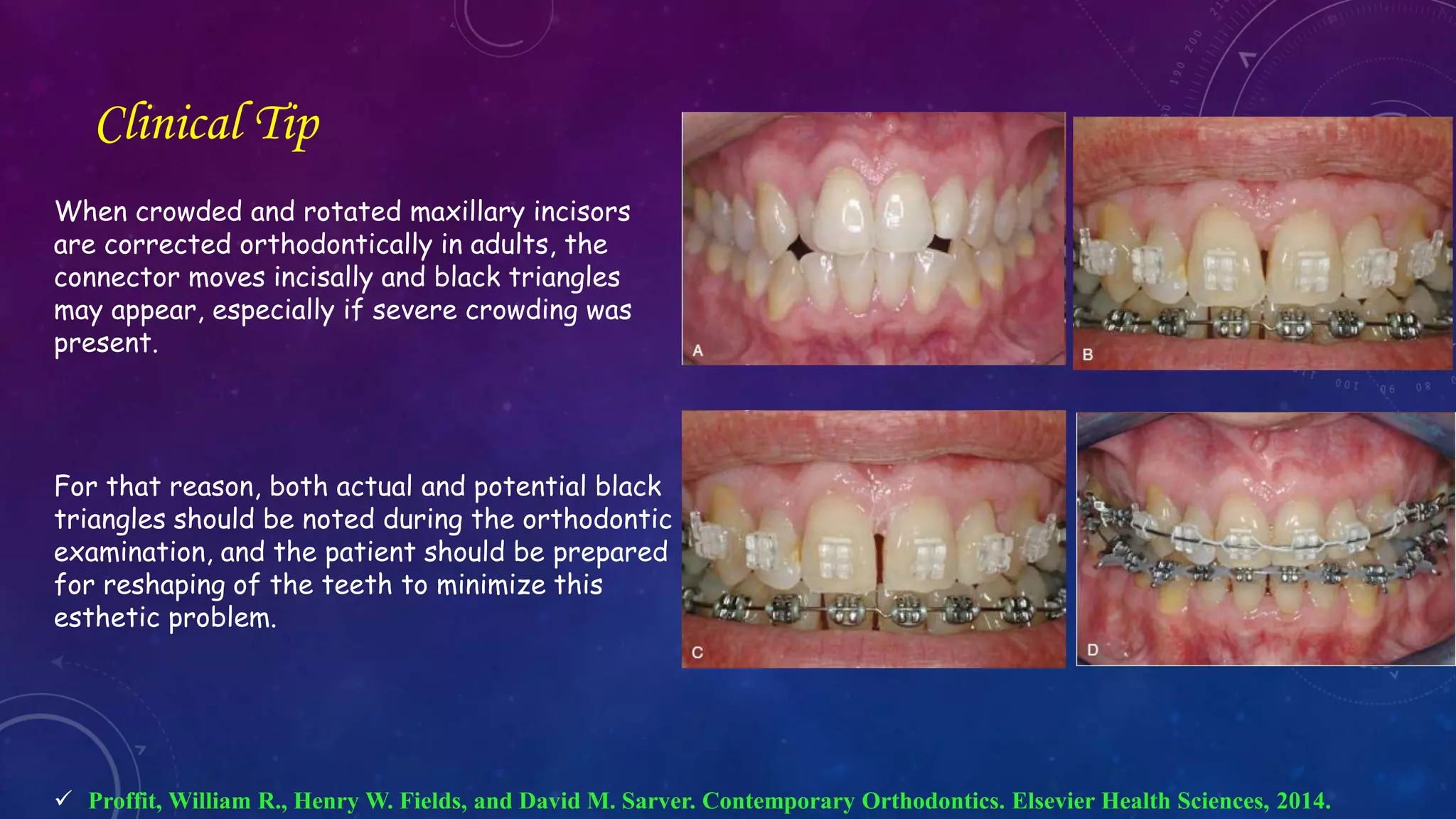 Orthodontic Correction of Rotated Teeth | PPTX