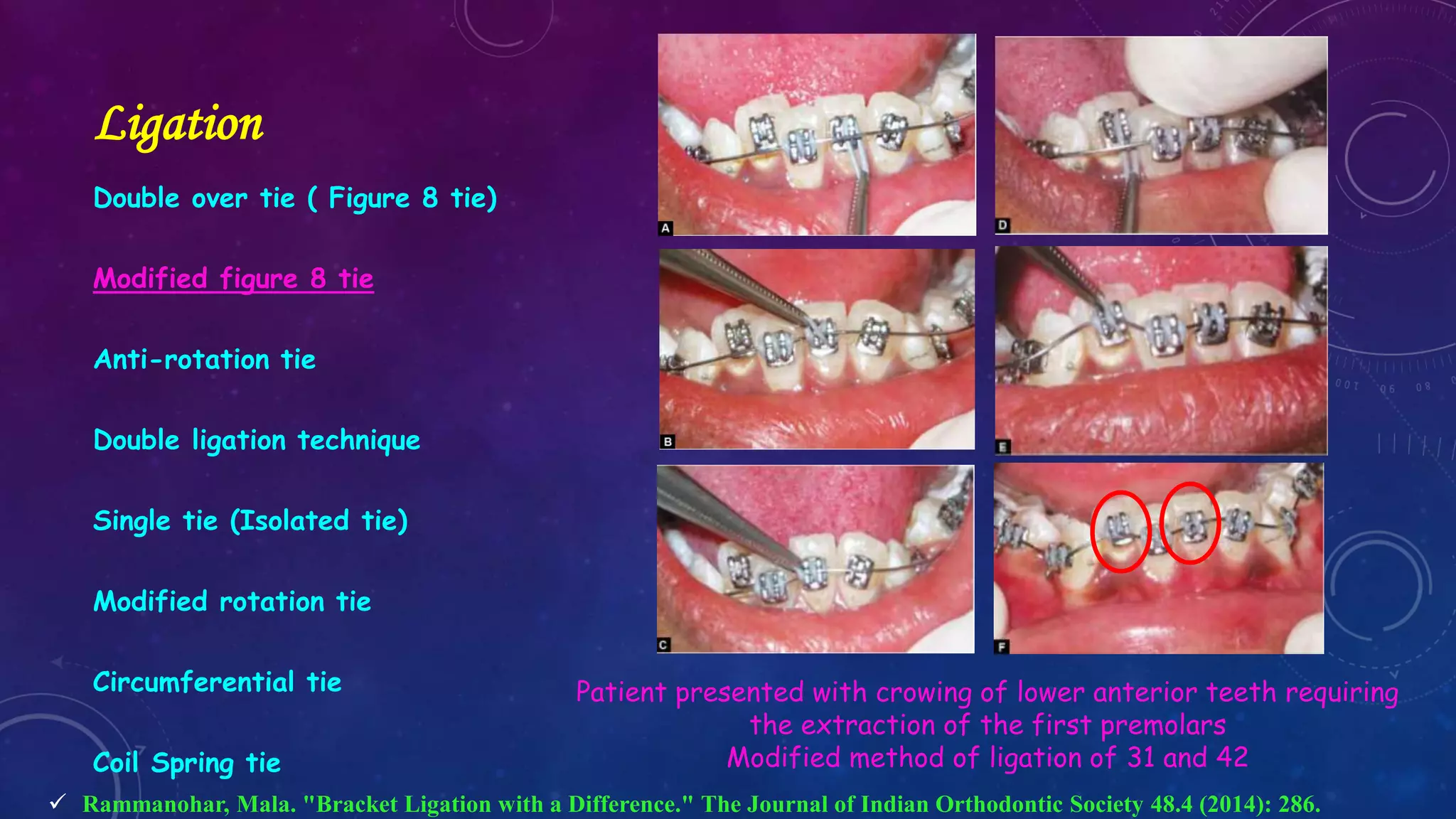 Orthodontic Correction of Rotated Teeth | PPTX