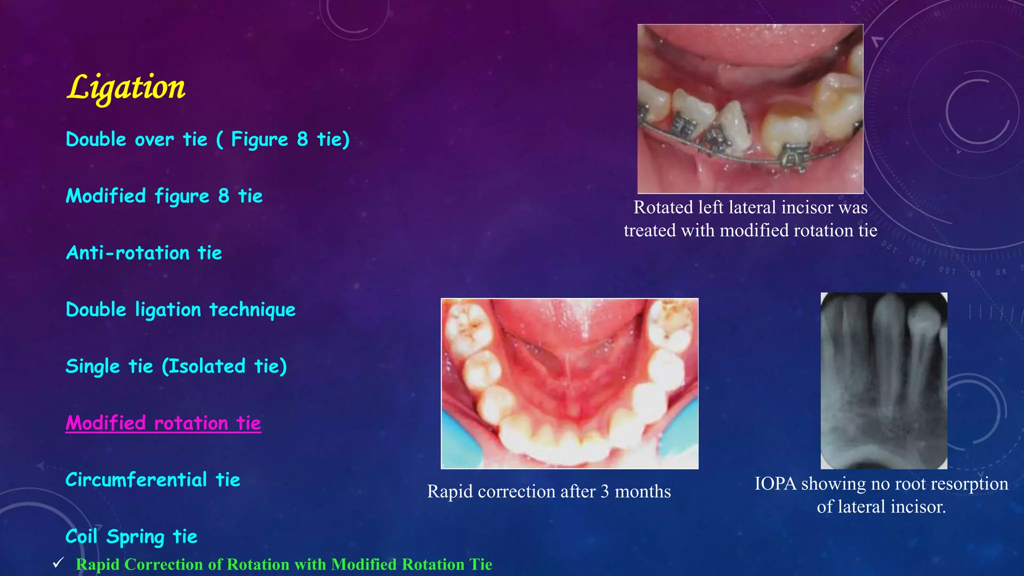 Orthodontic Correction of Rotated Teeth | PPTX