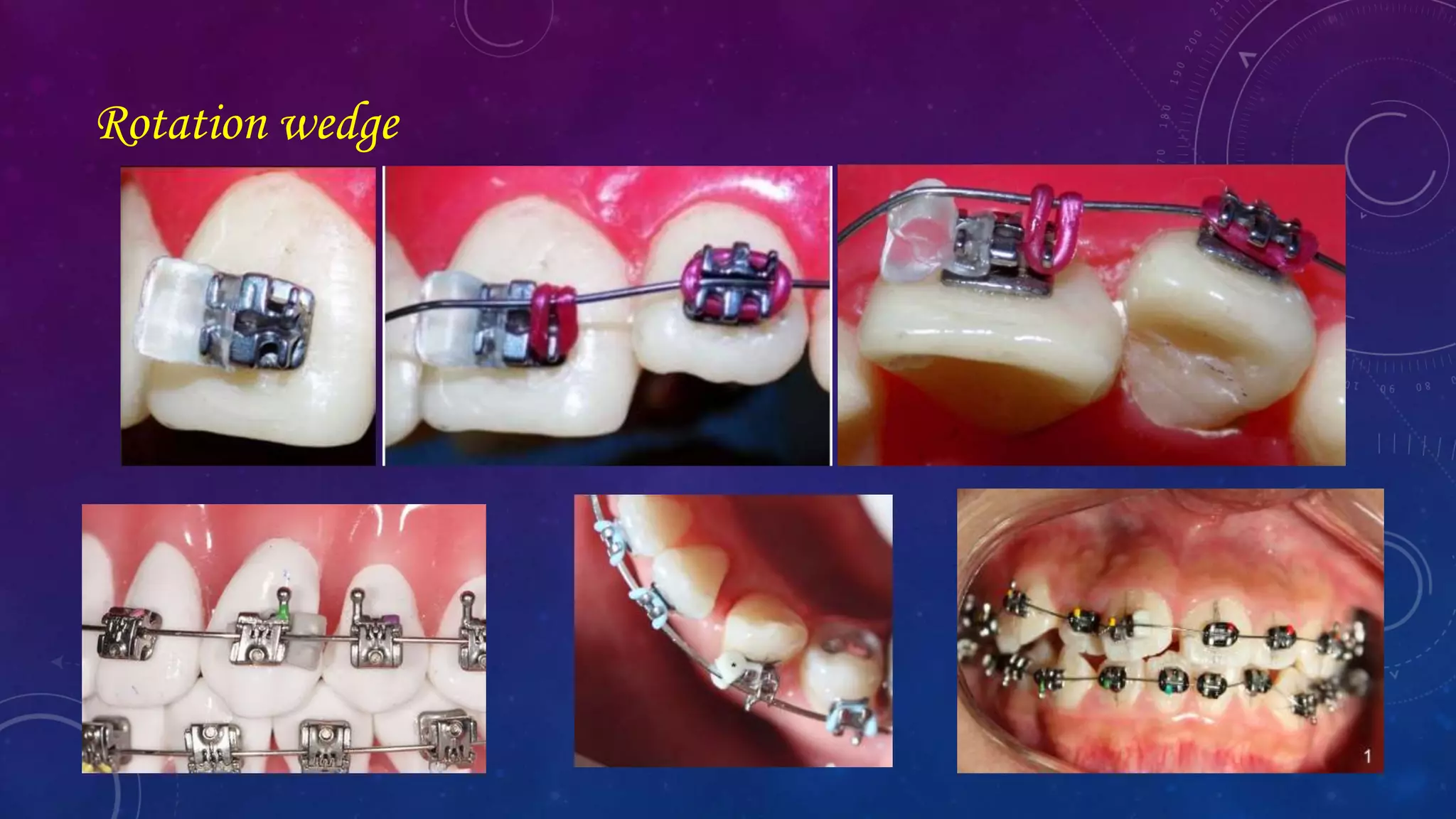 Orthodontic Correction of Rotated Teeth | PPTX