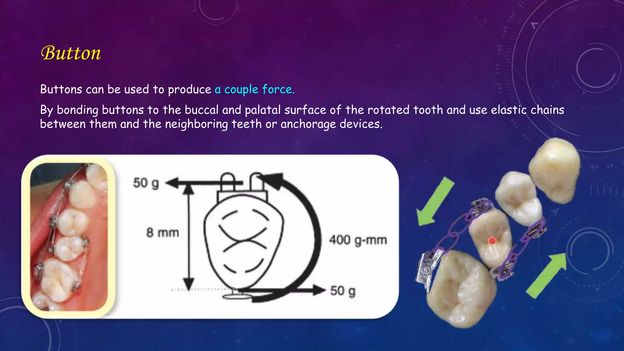 Orthodontic Correction of Rotated Teeth | PPTX