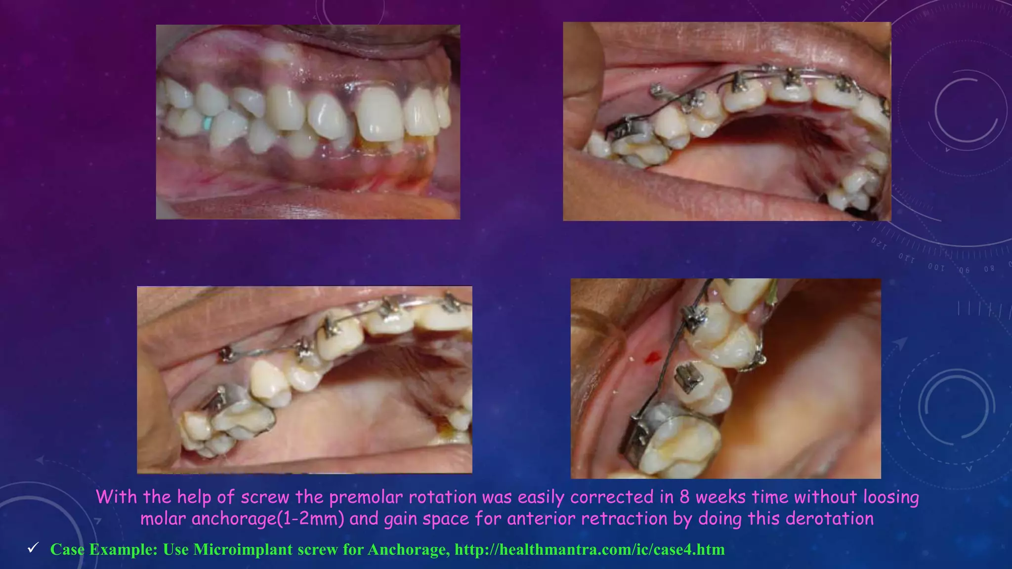 Orthodontic Correction of Rotated Teeth | PPTX