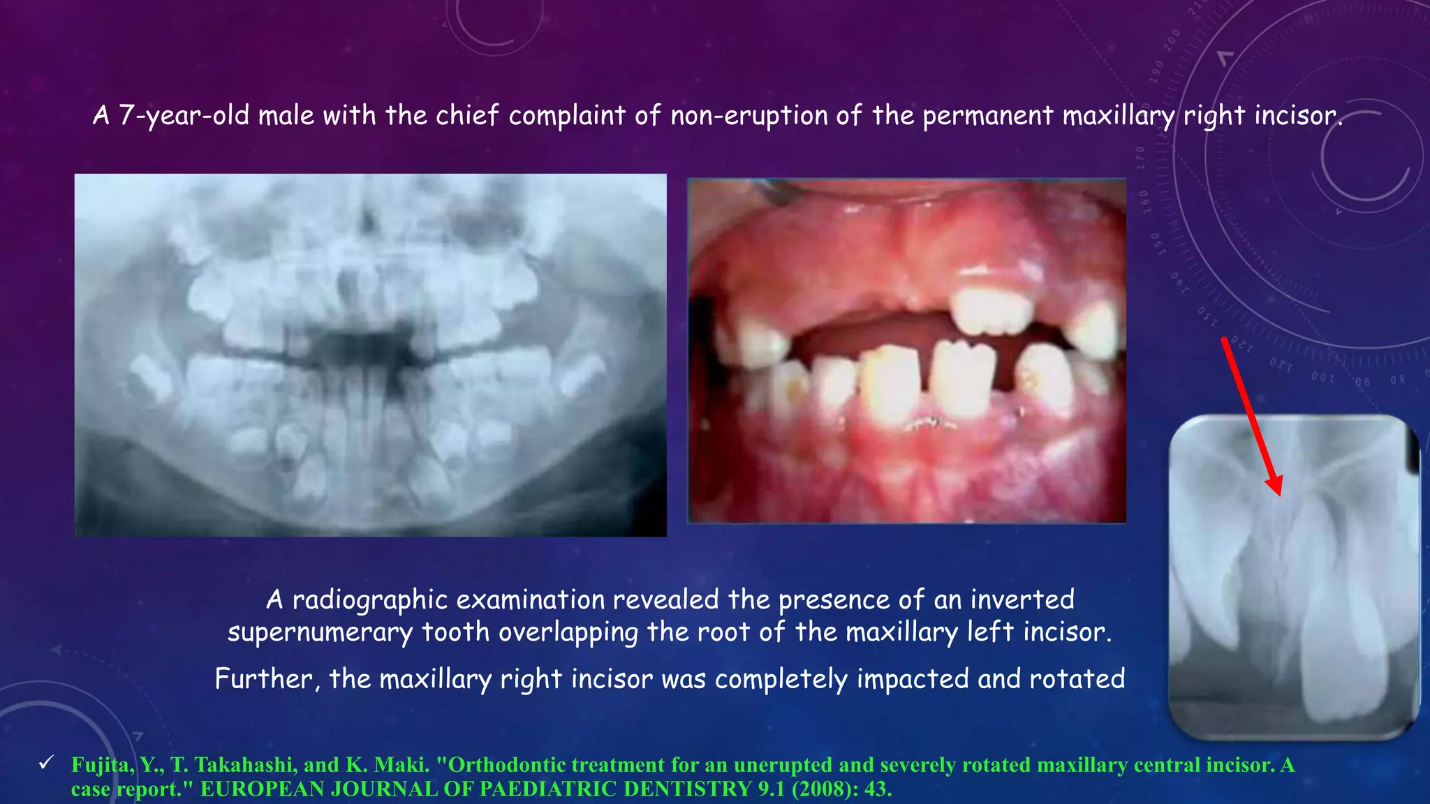 Orthodontic Correction of Rotated Teeth | PPTX