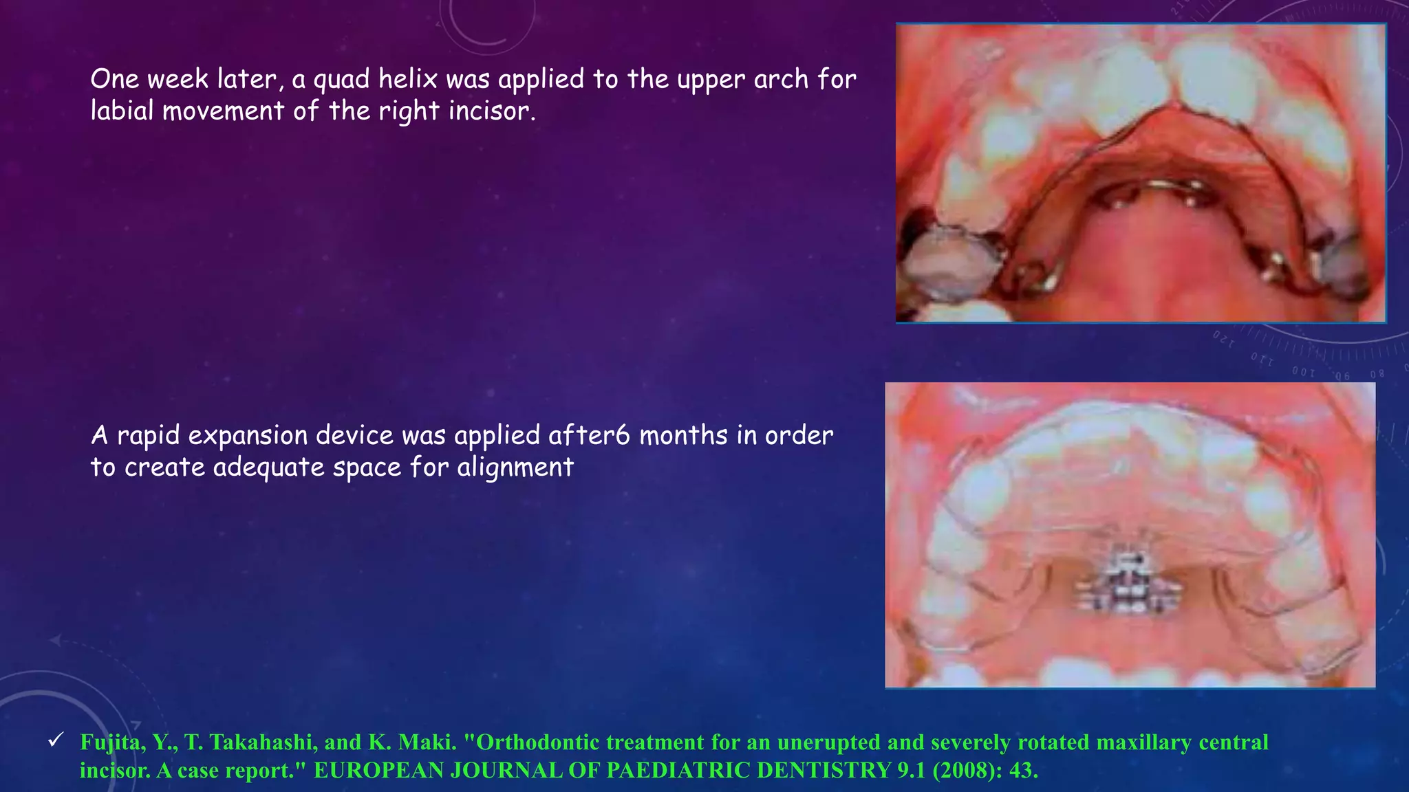 Orthodontic Correction of Rotated Teeth | PPTX