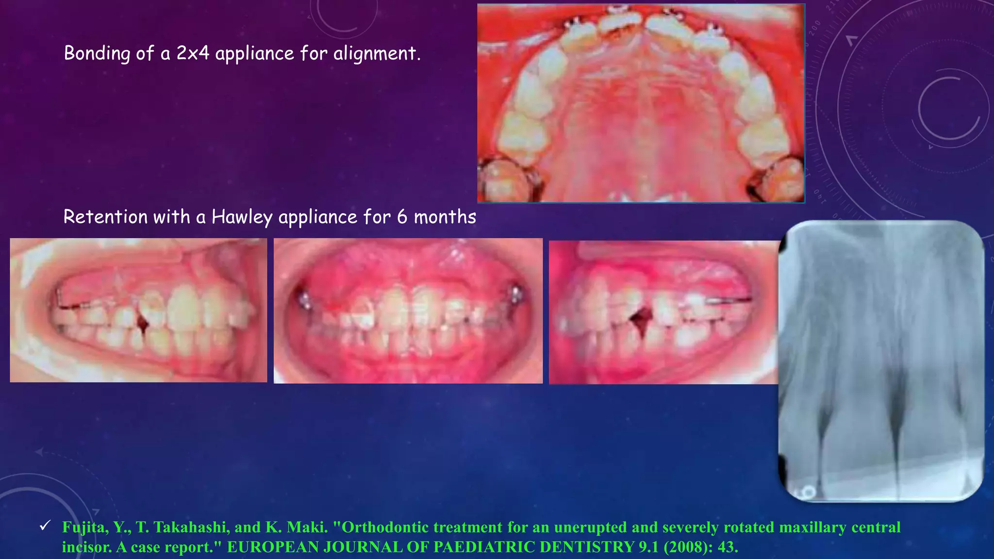 Orthodontic Correction of Rotated Teeth | PPTX