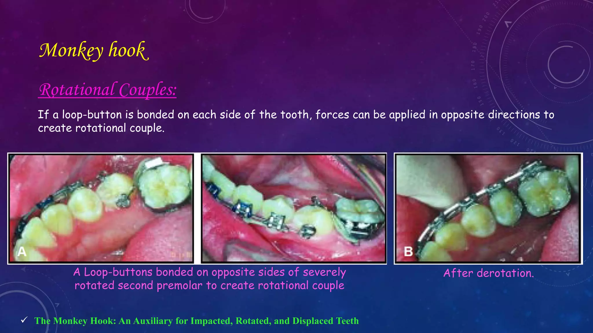 Orthodontic Correction of Rotated Teeth | PPTX