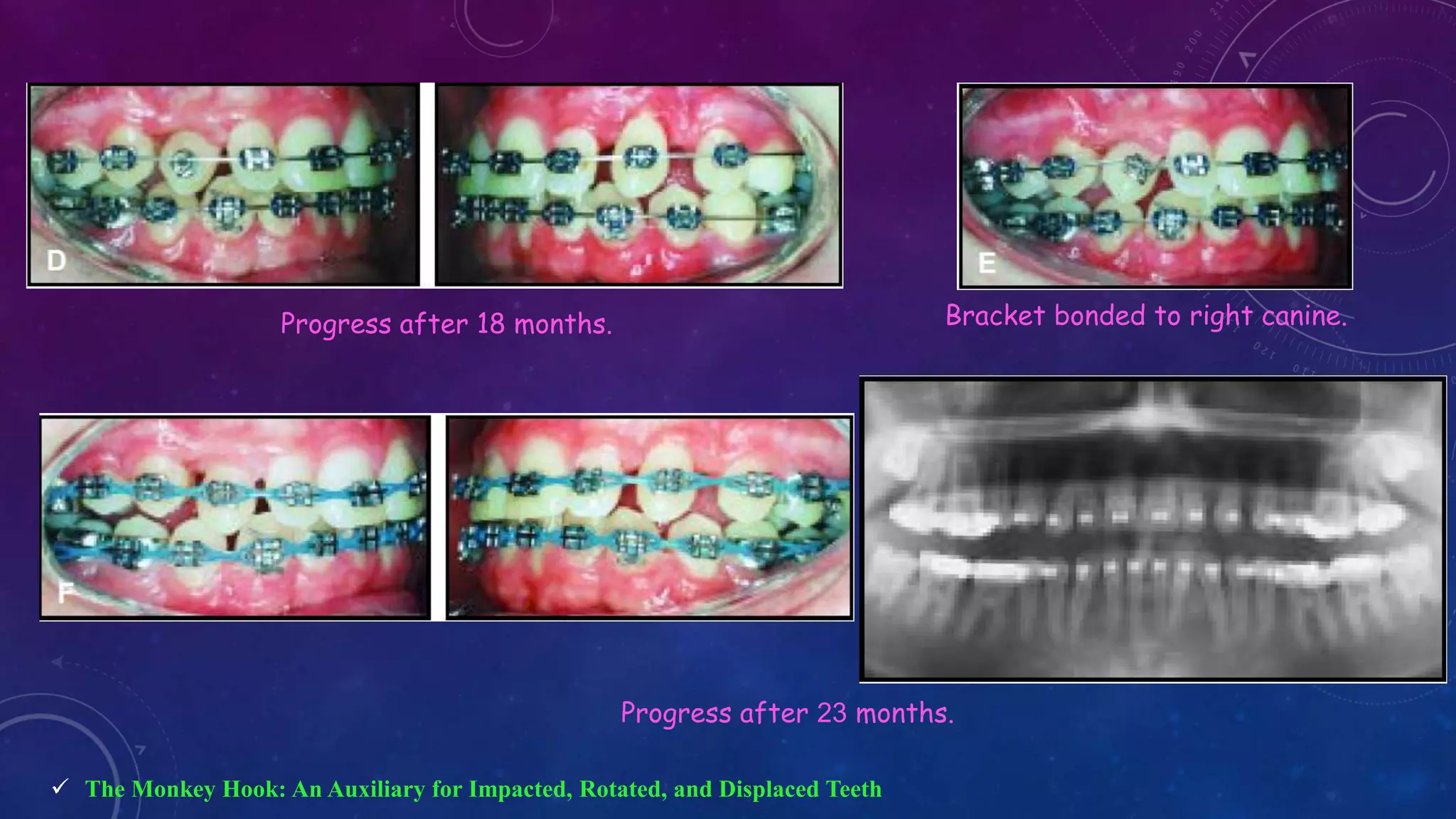 Orthodontic Correction of Rotated Teeth | PPTX