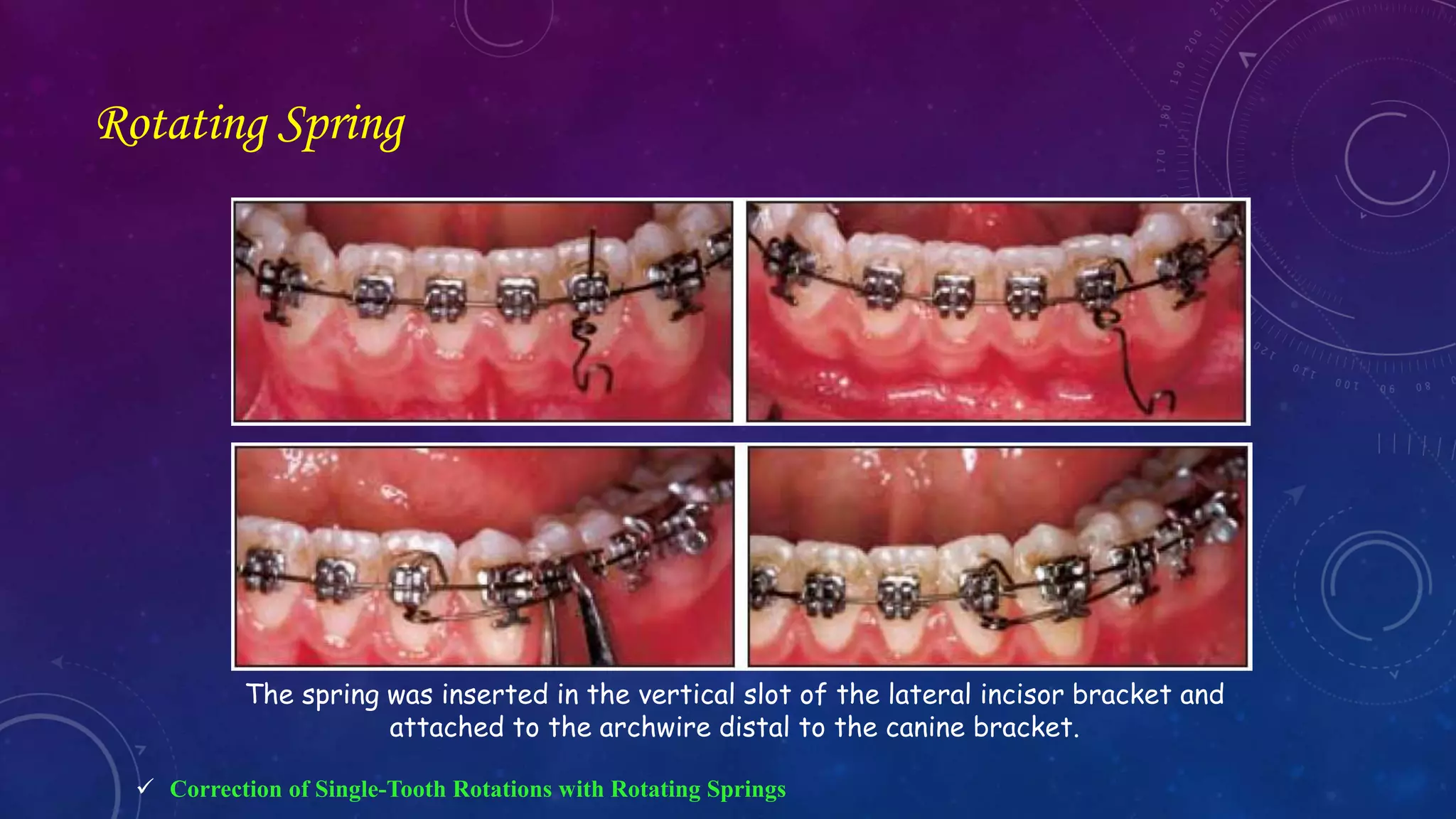 Orthodontic Correction of Rotated Teeth | PPTX