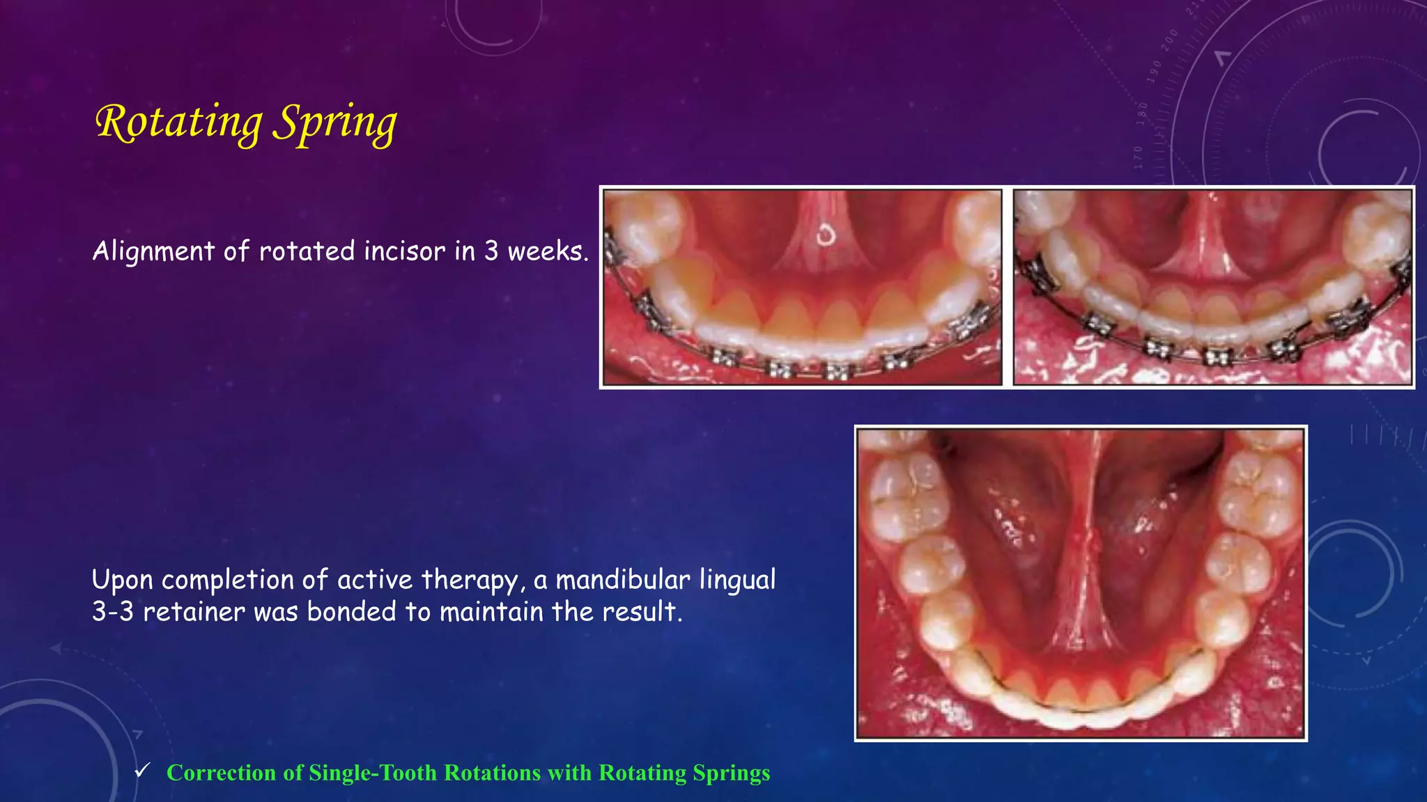 Orthodontic Correction of Rotated Teeth | PPTX