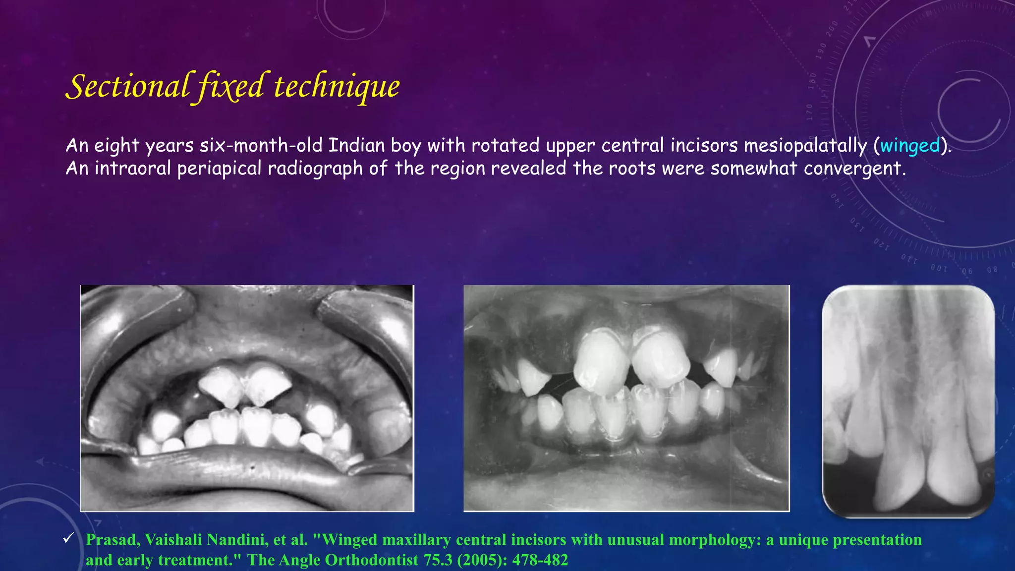 Orthodontic Correction of Rotated Teeth | PPTX