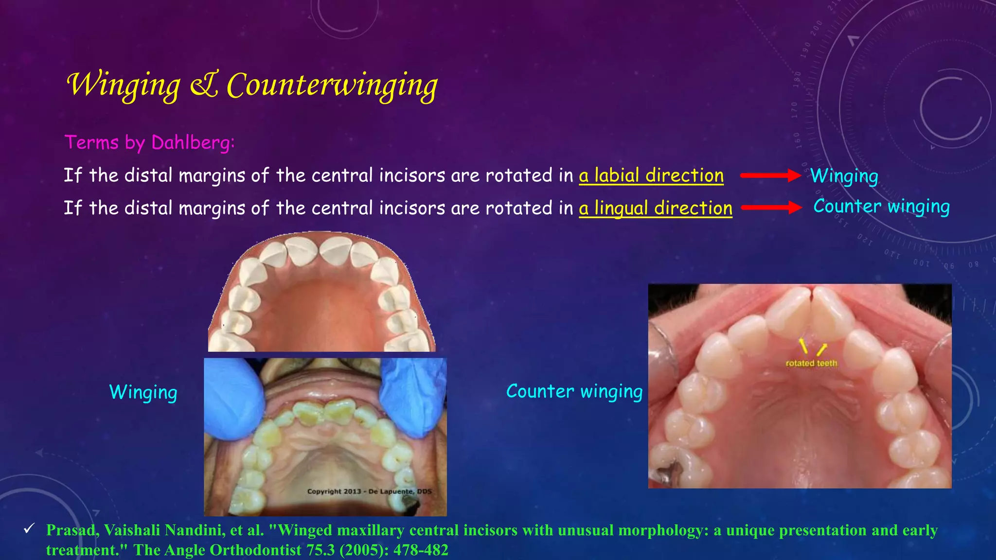Orthodontic Correction of Rotated Teeth | PPTX