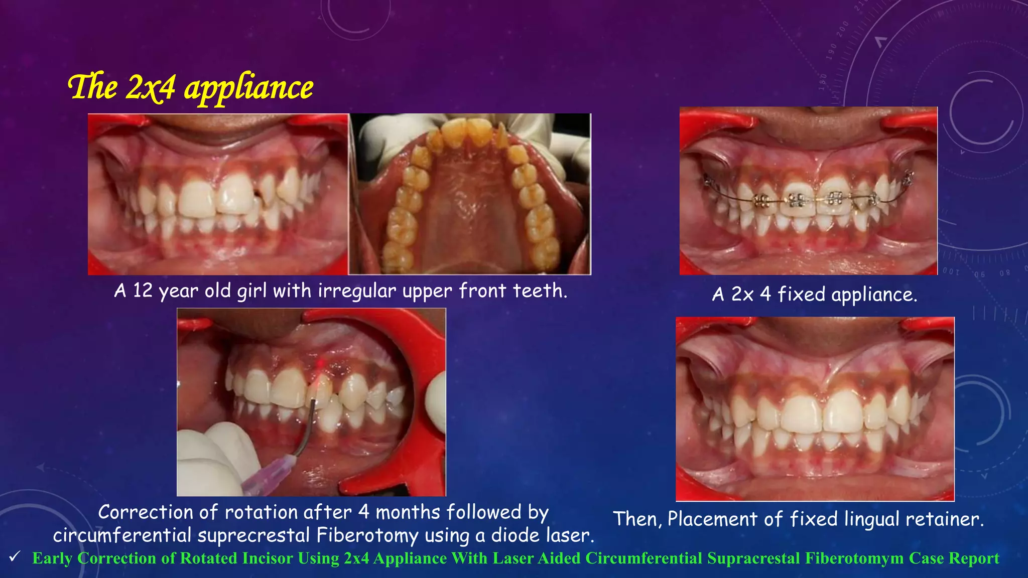 Orthodontic Correction of Rotated Teeth | PPTX
