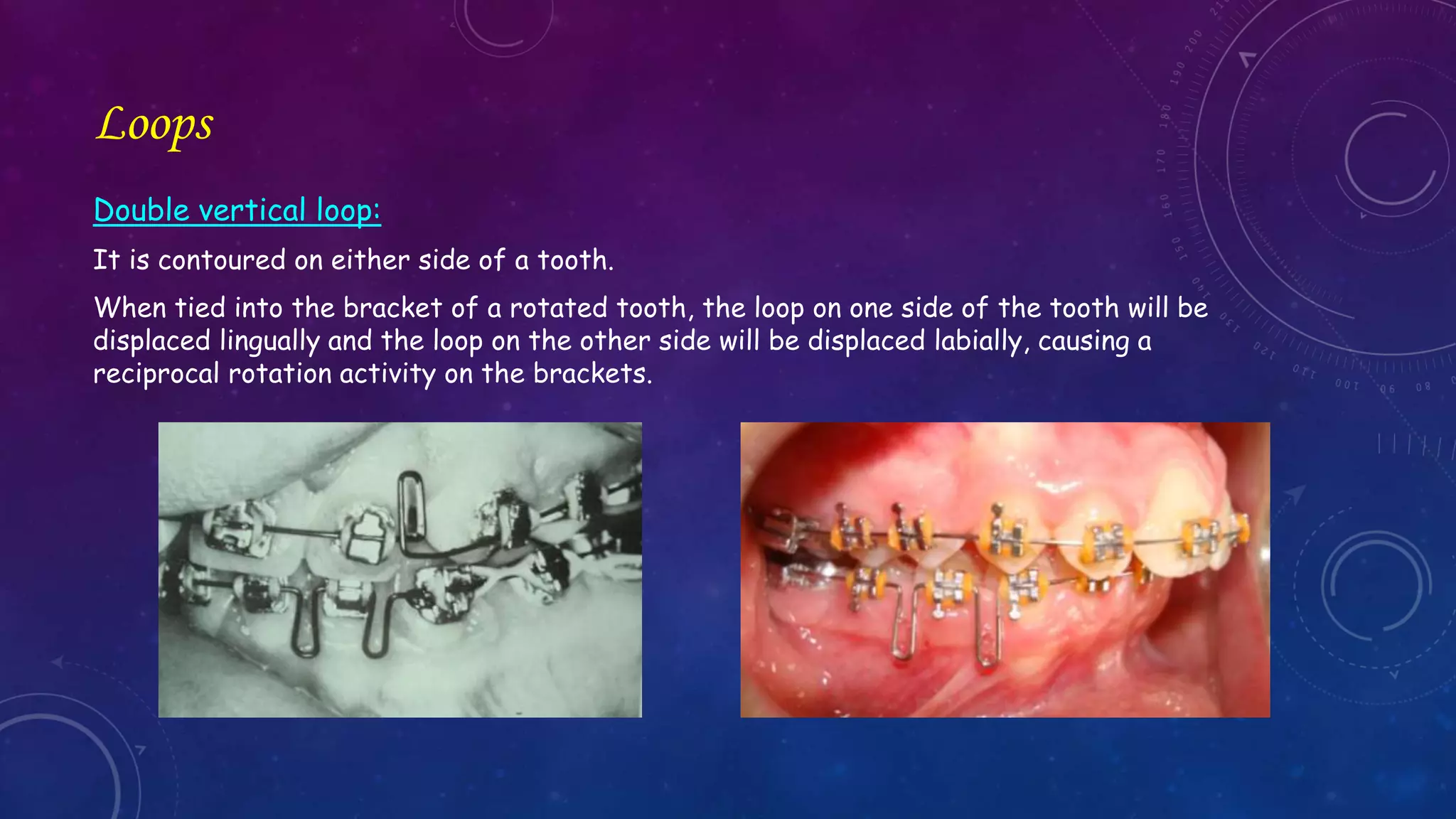 Orthodontic Correction of Rotated Teeth | PPTX