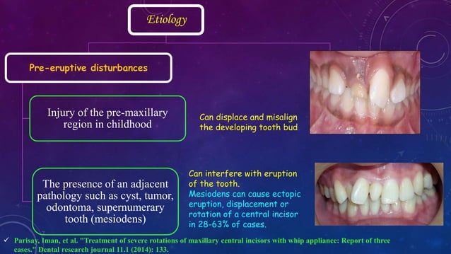 Orthodontic Correction of Rotated Teeth | PPTX | Dental Health ...