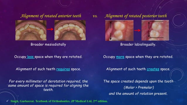 Orthodontic Correction of Rotated Teeth | PPTX | Dental Health ...