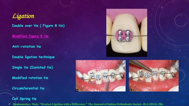 Orthodontic Correction of Rotated Teeth | PPTX | Dental Health ...