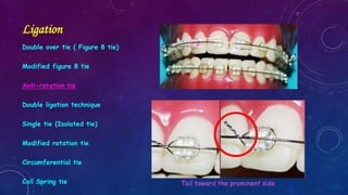 Orthodontic Correction of Rotated Teeth | PPTX