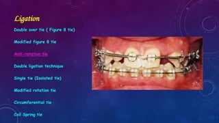 Orthodontic Correction of Rotated Teeth | PPTX