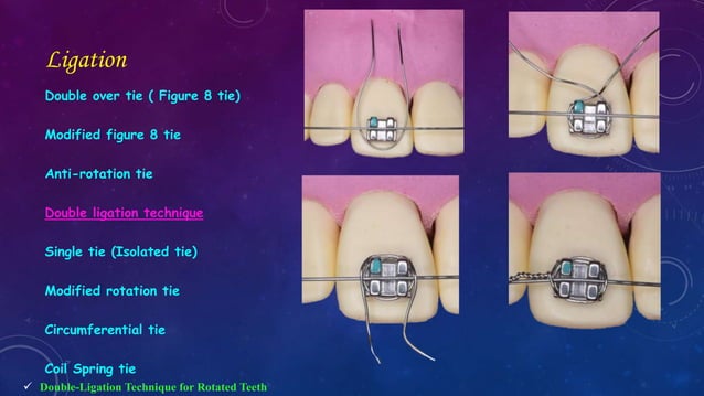 Orthodontic Correction of Rotated Teeth | PPTX | Dental Health ...
