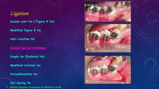 Orthodontic Correction of Rotated Teeth | PPTX