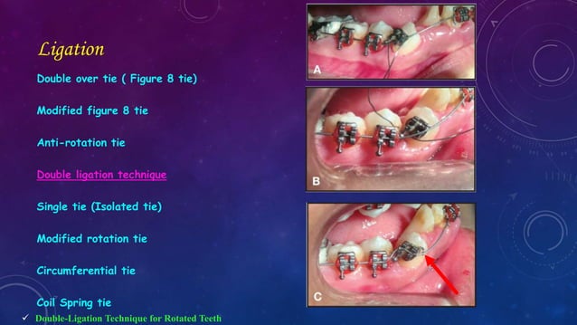 Orthodontic Correction of Rotated Teeth | PPTX | Dental Health ...