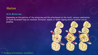 Orthodontic Correction of Rotated Teeth | PPTX