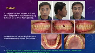 Orthodontic Correction of Rotated Teeth | PPTX