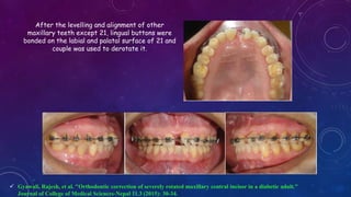Orthodontic Correction of Rotated Teeth | PPTX
