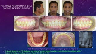 Orthodontic Correction of Rotated Teeth | PPTX