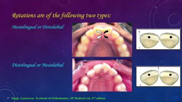 Orthodontic Correction of Rotated Teeth | PPTX | Dental Health ...
