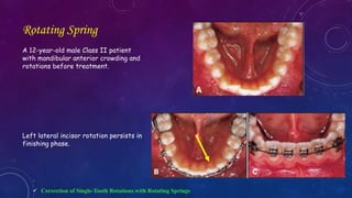 Orthodontic Correction of Rotated Teeth | PPTX