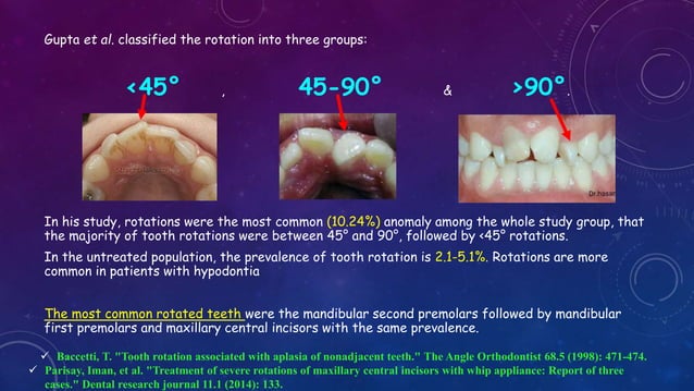 Orthodontic Correction of Rotated Teeth | PPTX | Dental Health ...