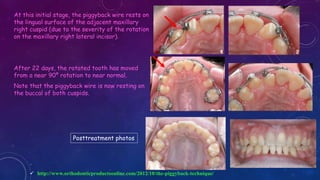 Orthodontic Correction of Rotated Teeth | PPTX