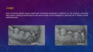 Orthodontic Correction of Rotated Teeth | PPTX