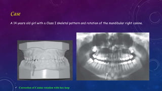 Orthodontic Correction of Rotated Teeth | PPTX