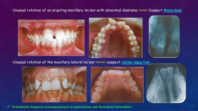 Orthodontic Correction of Rotated Teeth