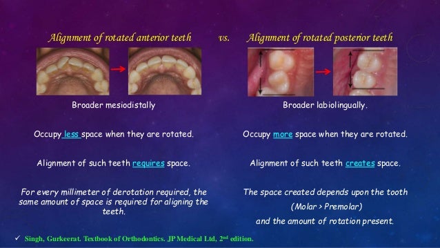 Orthodontic Correction of Rotated Teeth