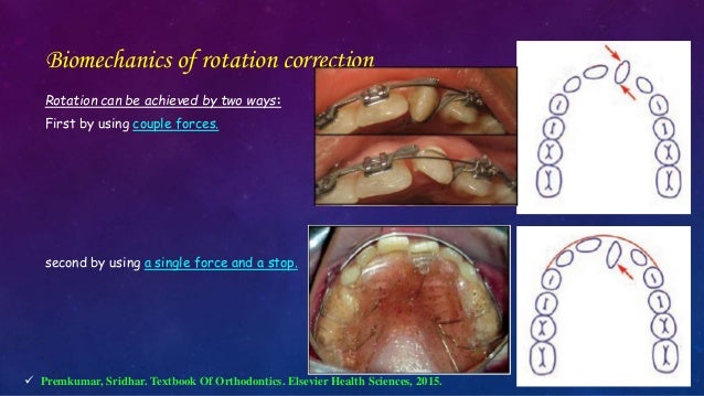 Orthodontic Correction of Rotated Teeth