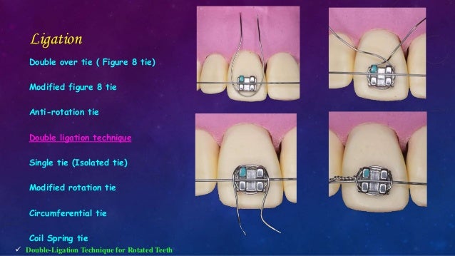 Orthodontic Correction of Rotated Teeth
