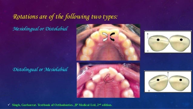 Orthodontic Correction of Rotated Teeth