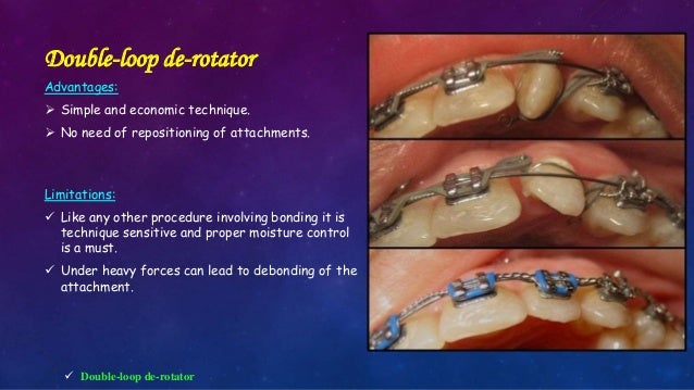 Orthodontic Correction of Rotated Teeth