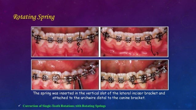 Orthodontic Correction of Rotated Teeth