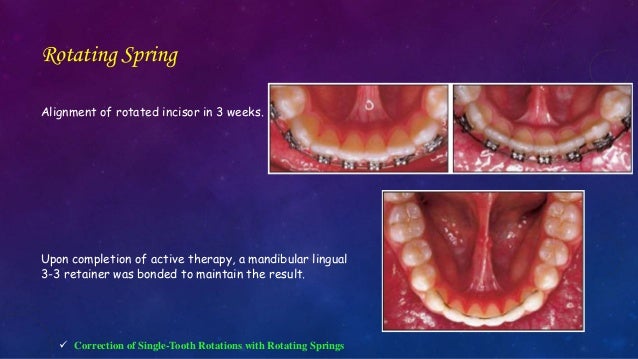 Orthodontic Correction of Rotated Teeth