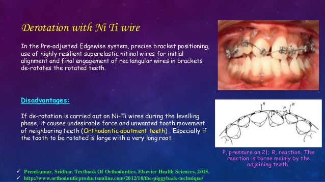 Orthodontic Correction of Rotated Teeth