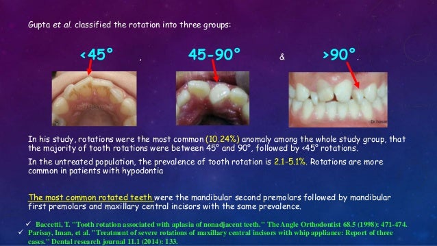 Orthodontic Correction of Rotated Teeth