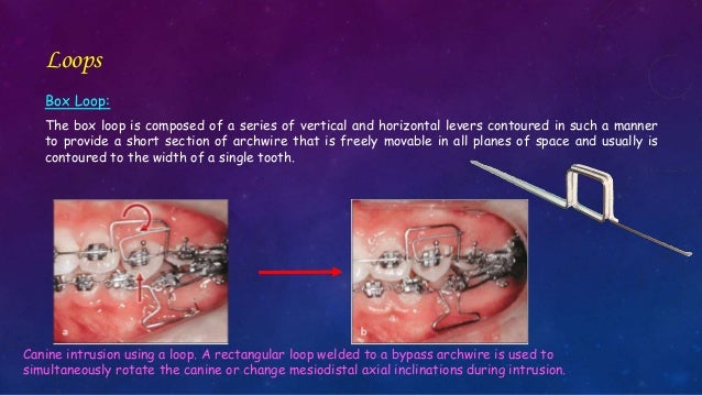 Orthodontic Correction of Rotated Teeth