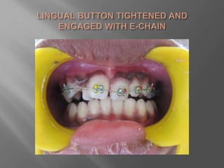 Orthodontic correction of rotated tooth | PPTX | Dental Health ...